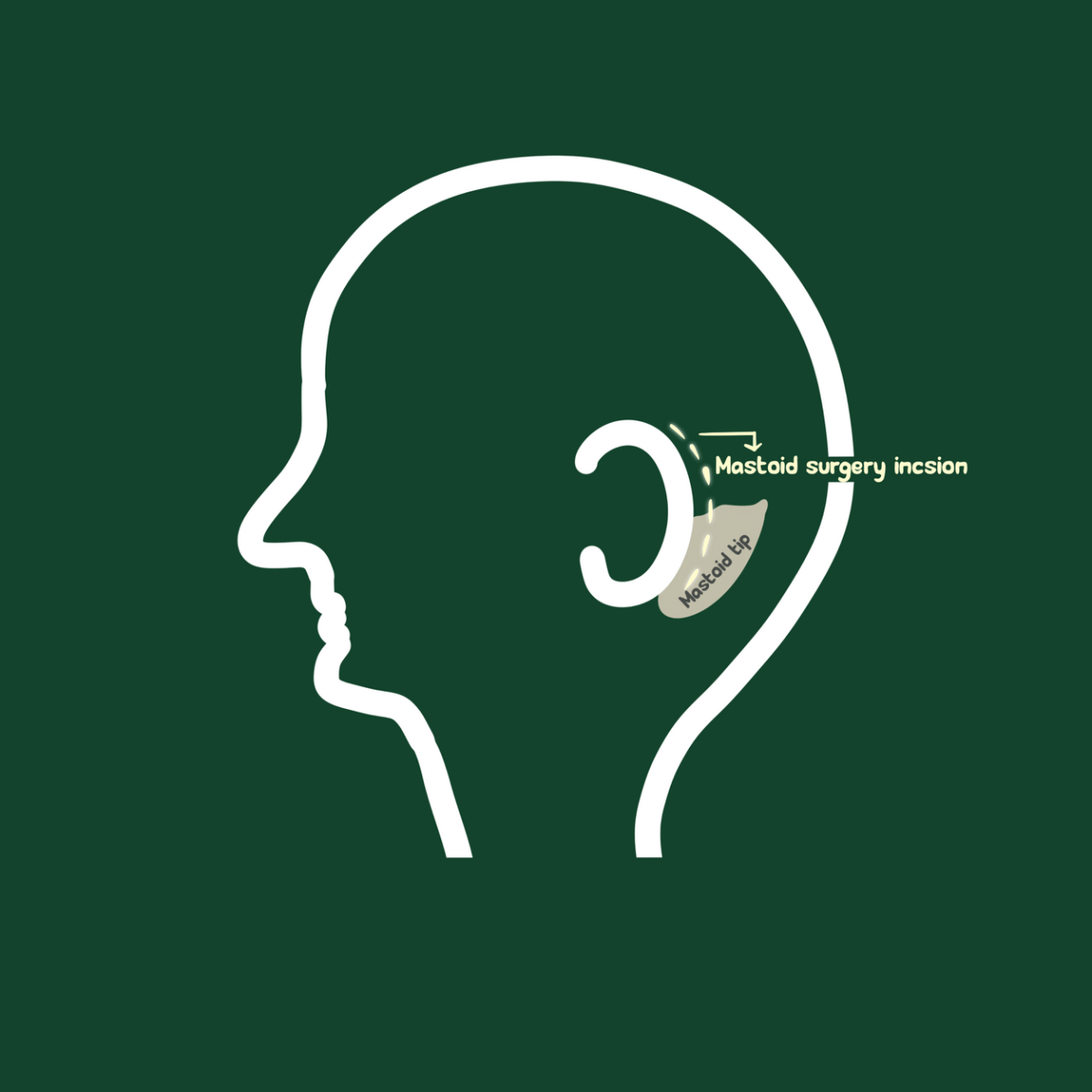 Mastoidectomy – Dr. Preethi Umamaheswaran MS DNB (ENT)