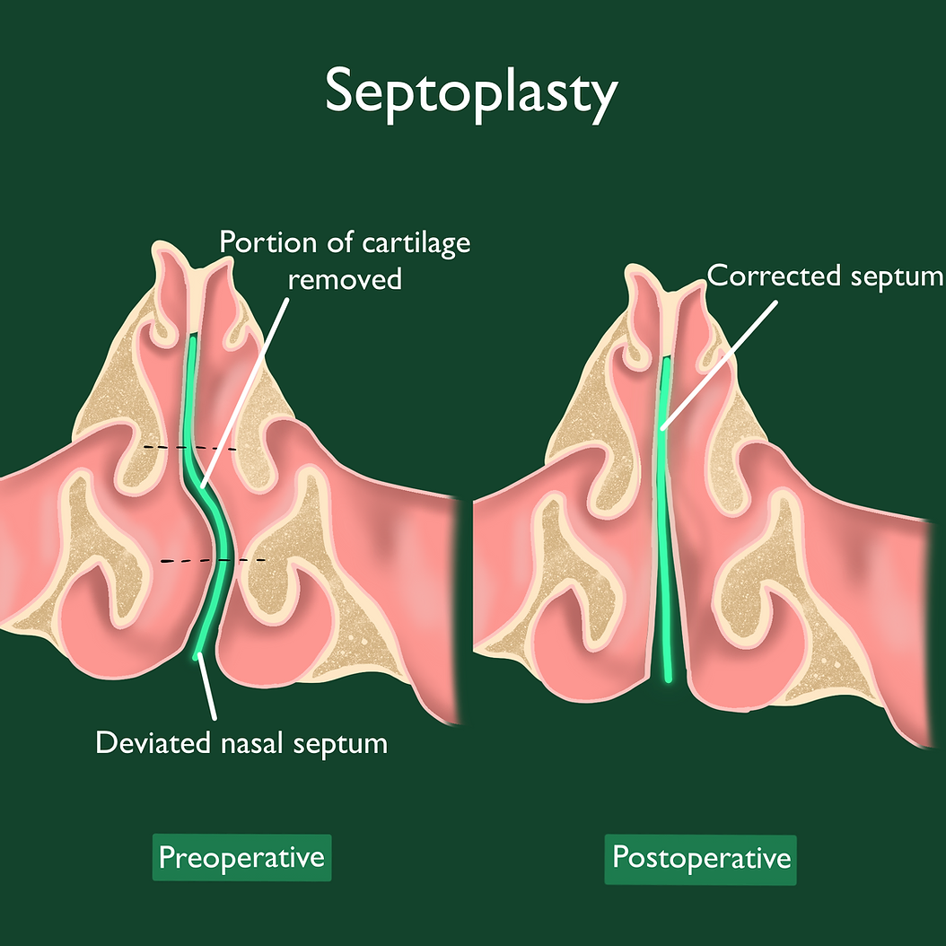 Endoscopic Septoplasty – Dr. Preethi Umamaheswaran MS DNB (ENT)