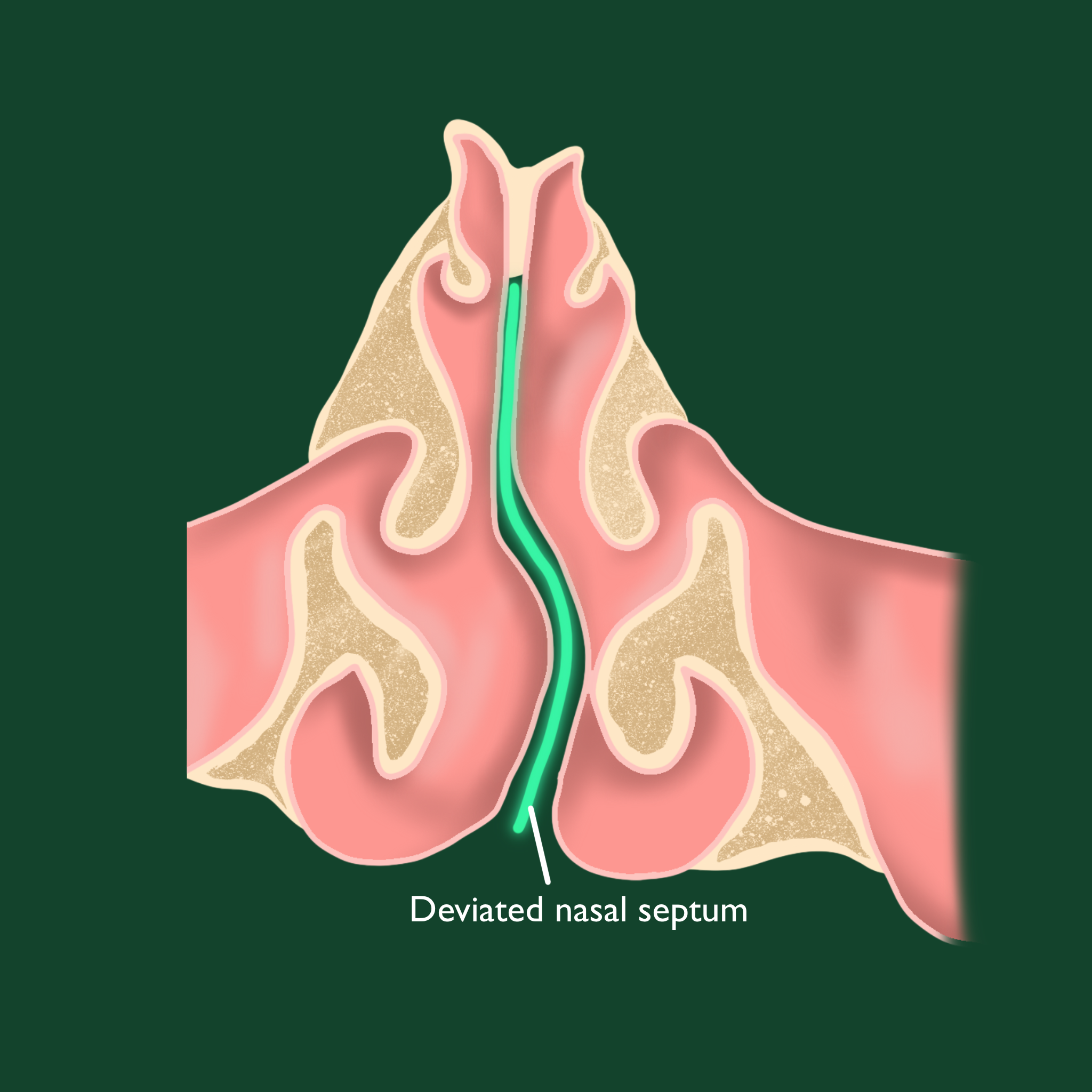 Straightening Out The Facts About Deviated Nasal Septum – Dr. Preethi ...