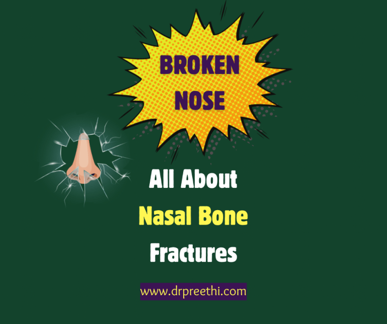 Broken Nose: Everything you need to know about nasal bone fractures ...