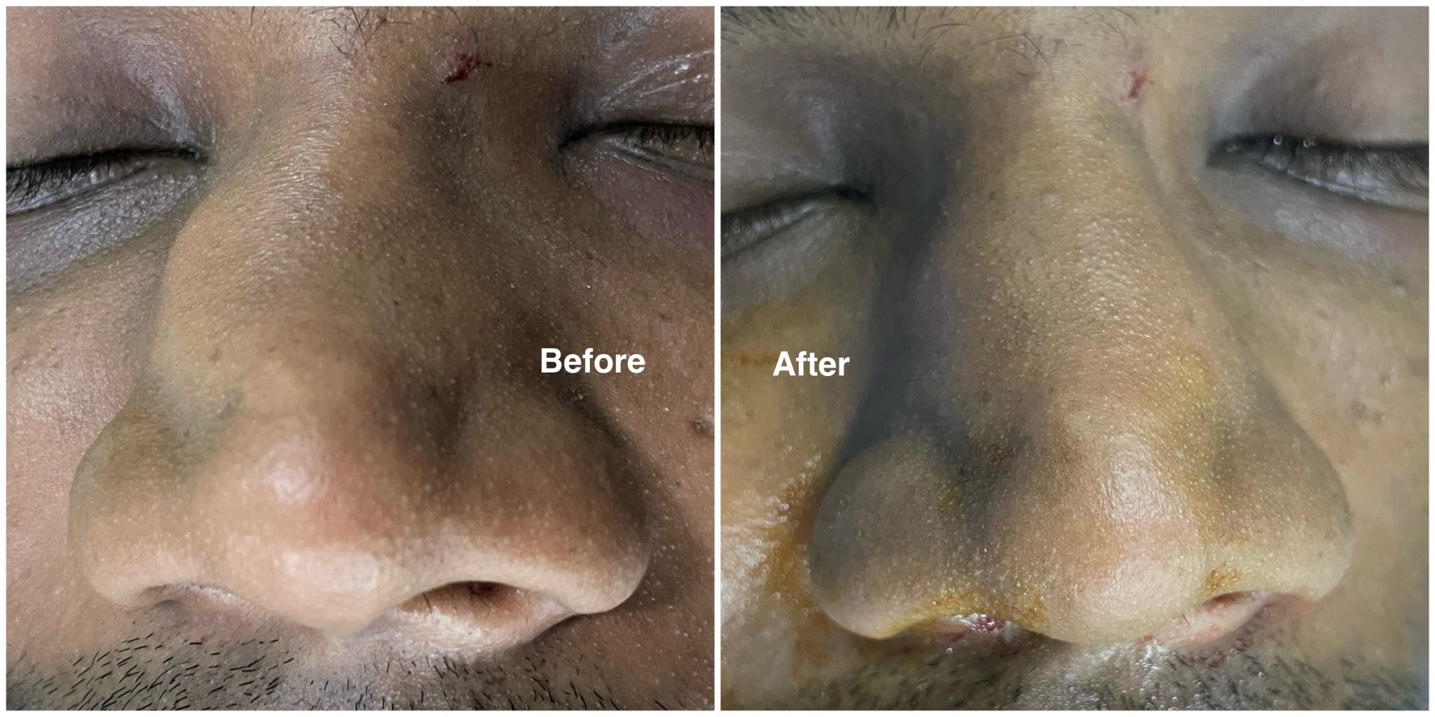 Broken Nose: Everything you need to know about nasal bone fractures ...