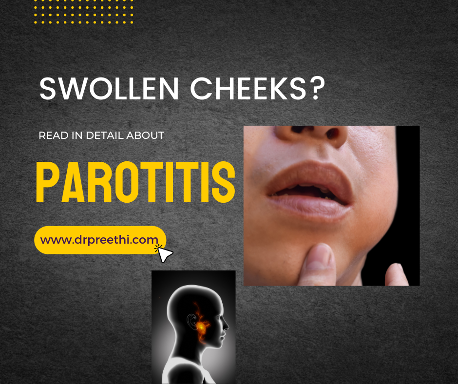 parotitis – Dr. Preethi Umamaheswaran MS DNB (ENT)