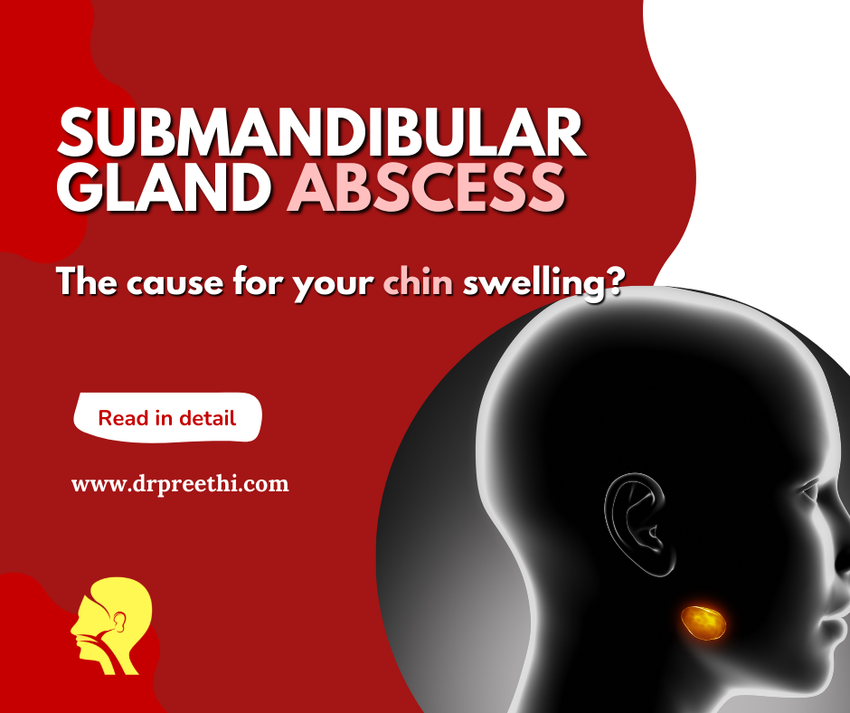 Understanding Submandibular Gland Abscess: Painful Swelling Under Your ...