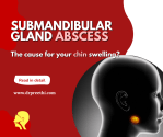 Understanding Submandibular Gland Abscess: Painful Swelling Under Your ...