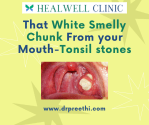 That white smelly Chunk from your mouth – tonsil stones / tonsilloliths ...